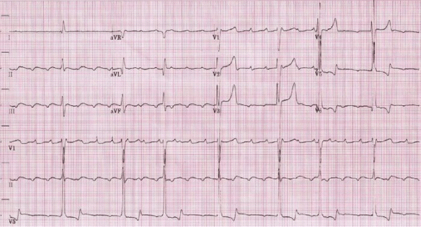 atrial-flutter – SCOPE