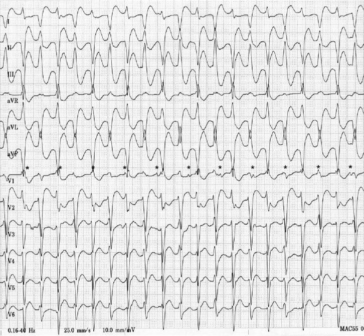 ecg-bidirectional-ventricular-tachycardia-bvt-4 – SCOPE